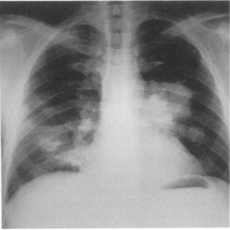 Shows The Correlation Between The Evolution Of Pulmonary Fungal