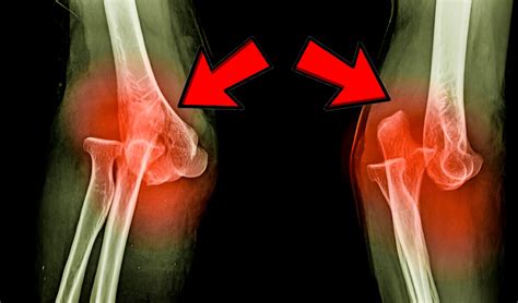 Elbow Dislocation Dr Oscar Brumby Rendell Orthopaedic Surgeon Adelaide