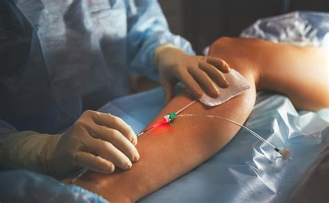 Laser Vein Ablation For Varicose Veins What Is It