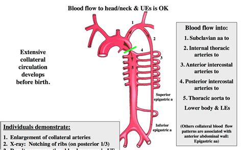 Preductal Coarctation Of Aorta