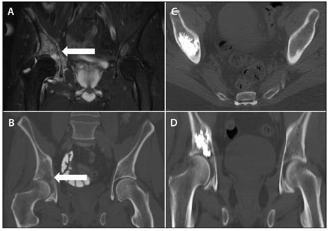 Metastatic Osseous Disease Current Interventional Oncology Treatment Options Endovascular Today