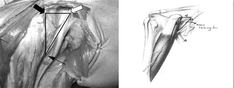 Triangular Area Coracoid Process Small Black Arrow Lateral Download Scientific Diagram