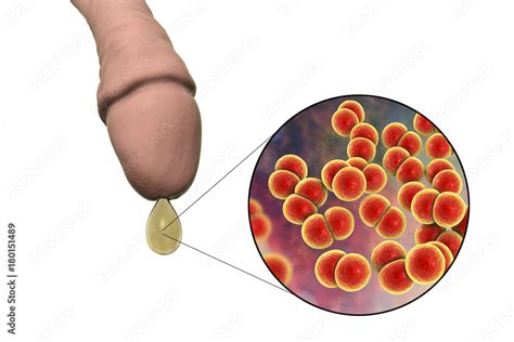 Male Gonorrhea 3d Illustration Showing Penis With Pus Dropping From