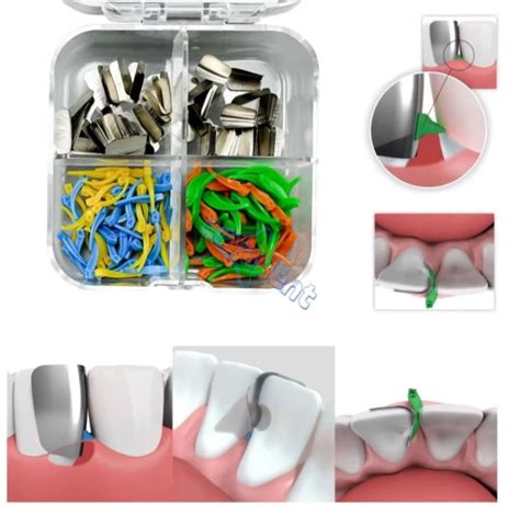 Anterior Matrix Kit And Wedges Umar Dental Emporium