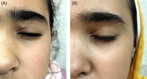 Left Eyelid Vitiligo A Before Treatment With Combined Microneedling