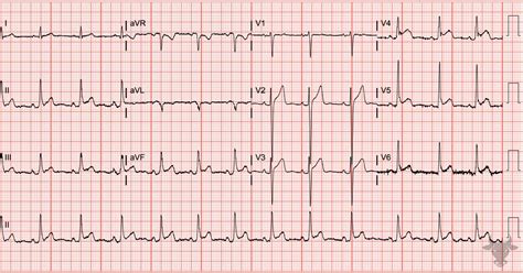 Acute Pericarditis Ecg Stampede