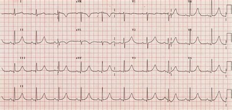 Benign Early Repolarisation Cuerpo Humano Imagenes Cuerpo Humano Cuerpo