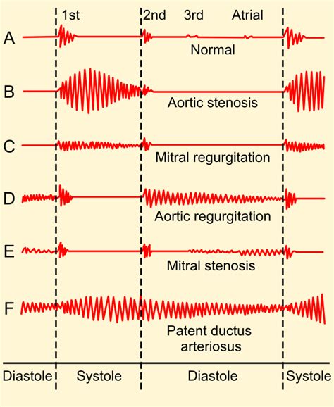 Mitral Valve Prolapse Sound