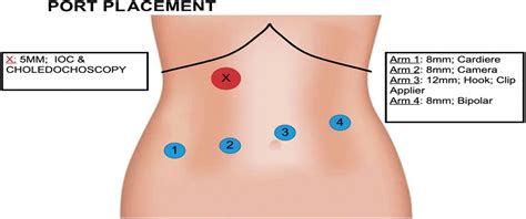 How I Do It Robotic Choledochoscopy Surgical Laparoscopy Endoscopy