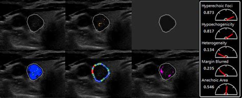 The Thyroid Lesion From Figure 5 Parameter 1 Microcalcification And