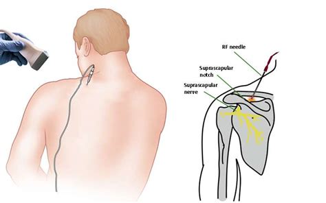 Suprascapular Nerve Impingement Treatment