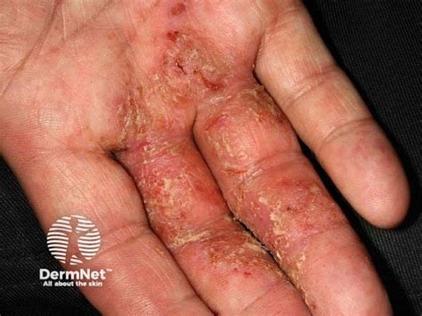 Test Your Knowledge Chronic Hand Eczema Dermatology Times