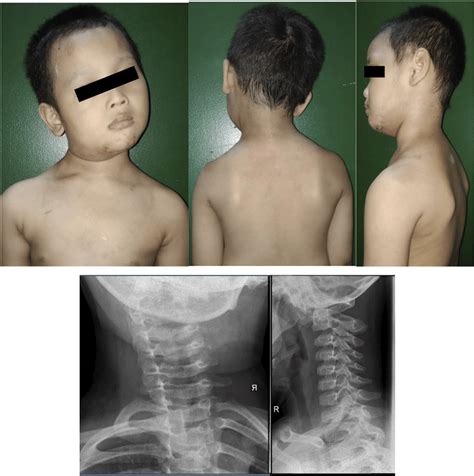Recurrent Aars Occurred 1 Month After The Initial Cons Download