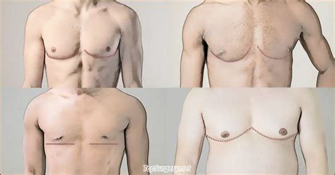 Best Ftm Bottom Surgery