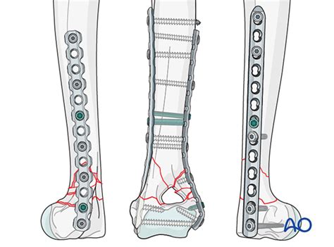 Double Buttress Plating For Complex Extra Articular Fractures Of The