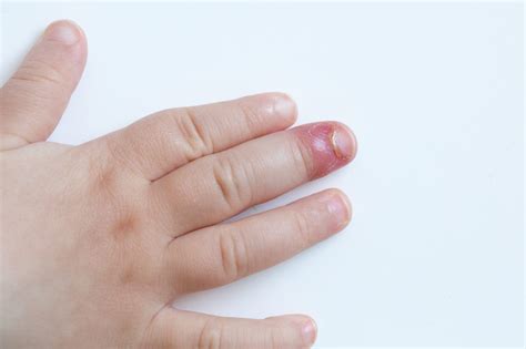 Paronychia Treatment Skin Infection Around The Nails