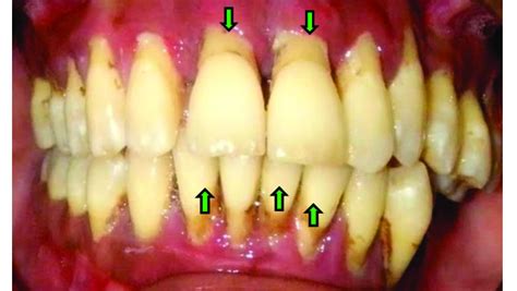 Photograph Of A Patient Affected With Advanced Periodontitis The