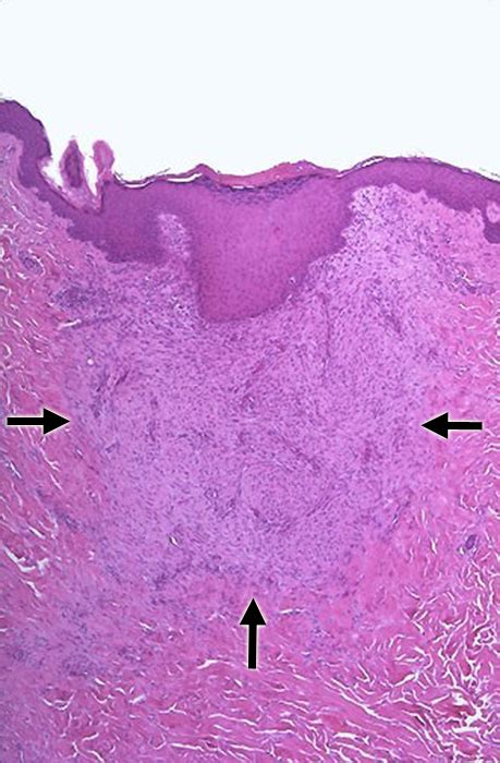 Image 25 Granulation Tissue