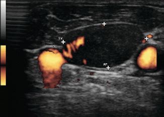 Ultrasound And Mapping Of Neck Lymph Nodes Radiology Key