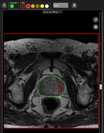 Fusion Biopsy Prostate Biopsy Fusing Mri W Ultrasound