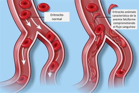 Eritrocitos Anemia Falciforme Hgrni Genotipia
