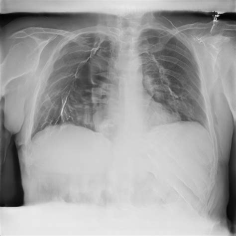 Cxr Cxr Jsliy Roboflow Universe