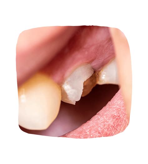 Dealing With A Broken Tooth Emergency Dentistry Dental Faith