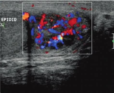 Color Doppler Sonography Reveal Increased Vascularity Of The Epididymal Download Scientific