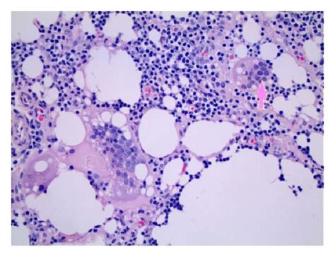 Inguinal Lymph Node Excisional Biopsy Showing Giant Cells Arrow