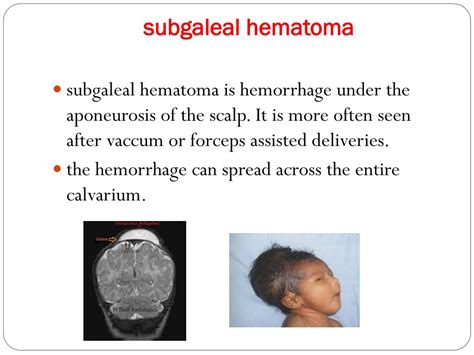 Ppt Birth Injuries Powerpoint Presentation Free Download Id 8807790