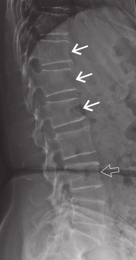 Difficult Call Distinguishing Between Physiological Wedging Of The