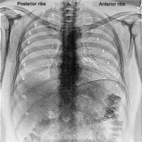 Posterior Ribs Anatomy Xray