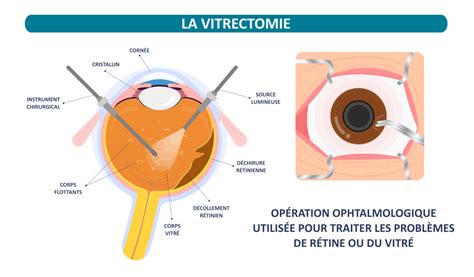Pathologies Rétiniennes Ophtamaine Le Mans 72