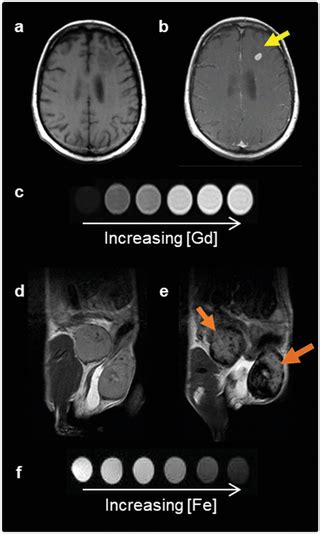 Two Classes Of Mri Contrast Agents A Pre‐ And B Post‐ Gbca
