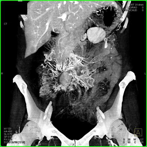 Carcinoid Tumor With Mesenteric Mass And Desmoplastic Reaction And