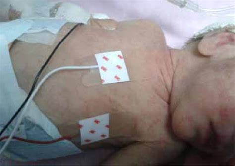 Diffuse Maculopapular Skin Rashes Seen On Day 2 Download Scientific Diagram