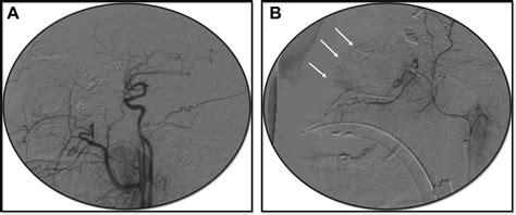 Current Treatment Strategies For Epistaxis A Multidisciplinary
