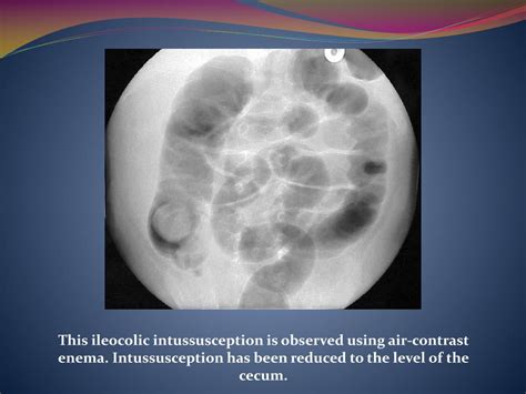 Ppt Intussusception Powerpoint Presentation Free Download Id1973263