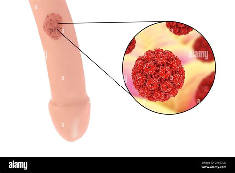 Penile Condylomata