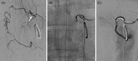 Comparison Of Nbca And Onyx For Embolization Of Spinal Dural