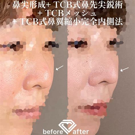 症例写真 ：鼻尖形成 美容整形はtcb東京中央美容外科