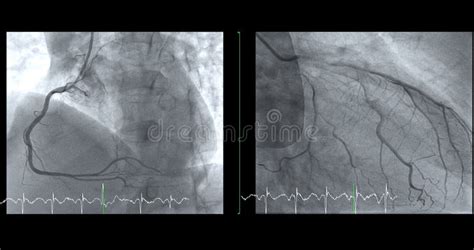 Cardiac Catheterization On Rca And Lad Can Help Doctor Diagnose And Treat Problems In Your Heart