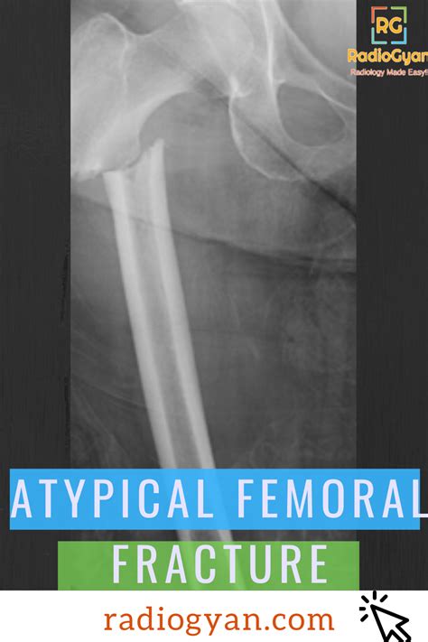 Types Of Femoral Fractures Radiology At Eliza Sizer Blog