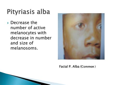 Ppt Eczema And Dermatitis Powerpoint Presentation Free Download Id