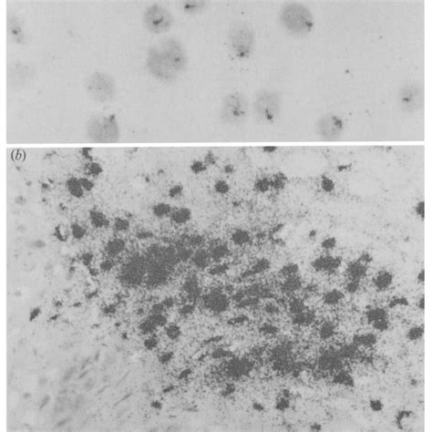 In Situ Hybridization Detection Of Ebv Dna A Aw Ramos Cells 1 Ebv