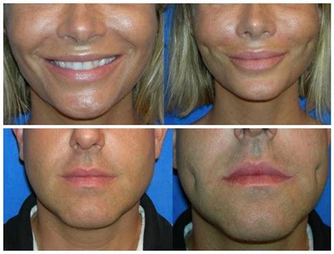 Deep Dimples Surgery How Can I Correct These Two Deep Dents Dimples