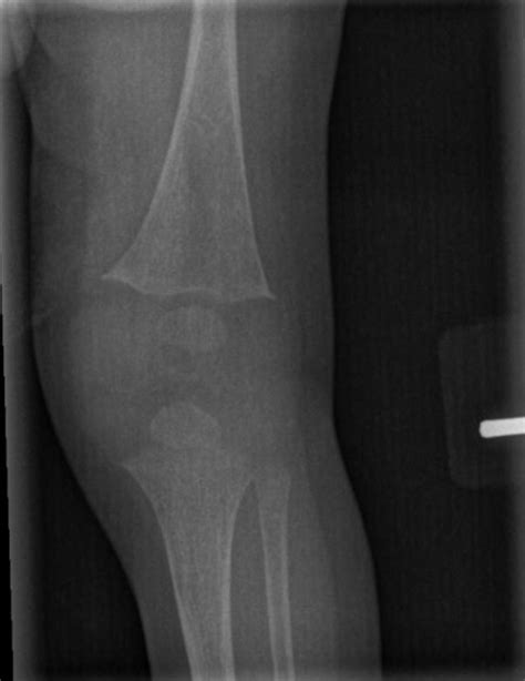 Rickets X Ray