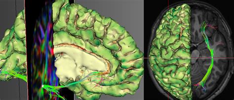 Uncinate Uncinate Process Of Ethmoid Bone Processus Uncinatus