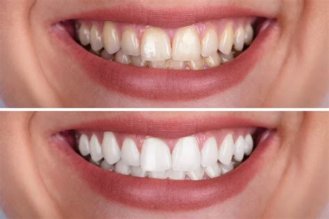 How Much Does It Cost To Get Teeth Professionally Whitened Dentfirst