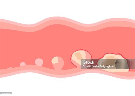Stage Of Growth Polyp In Malignant Tumor Inside Wall Of Organ Risk Cancer Human Digestive System